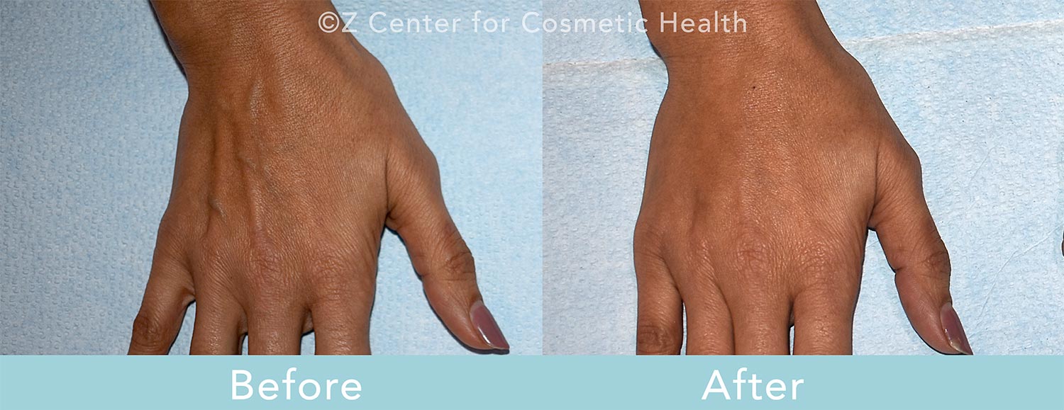 Dermal Fillers Before & After Gallery | Z Cosmetic Health