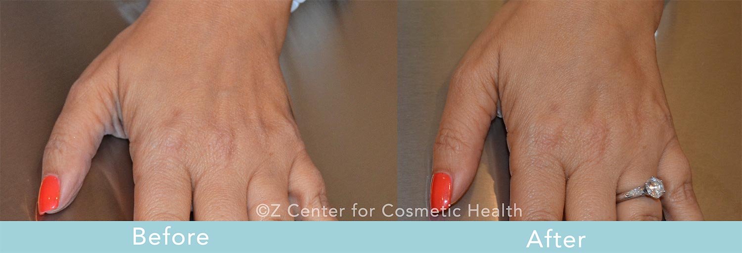 Dermal Fillers Before & After Gallery | Z Cosmetic Health