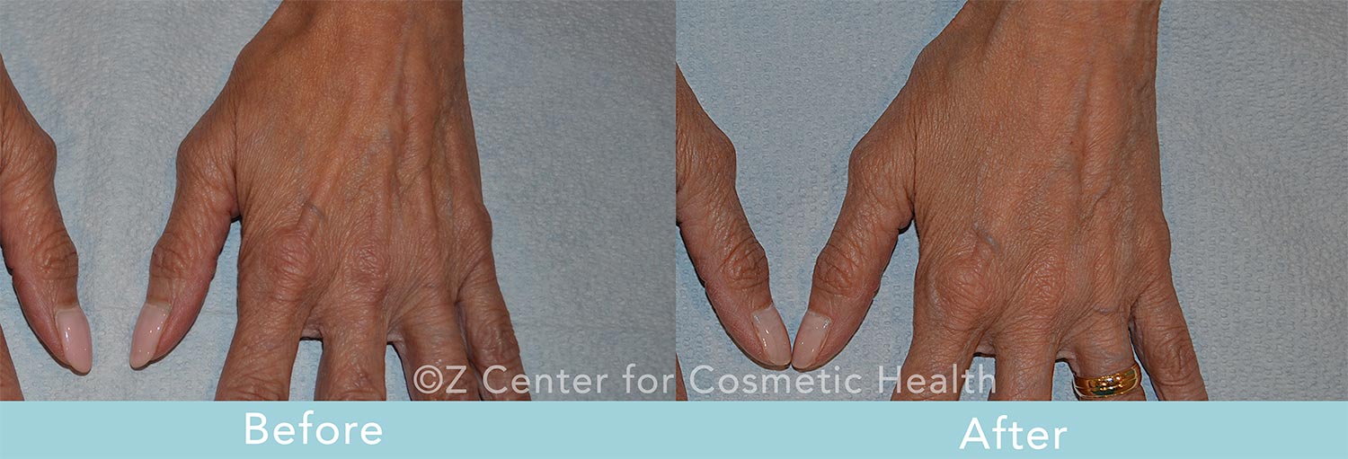 Dermal Fillers Before & After Gallery | Z Cosmetic Health