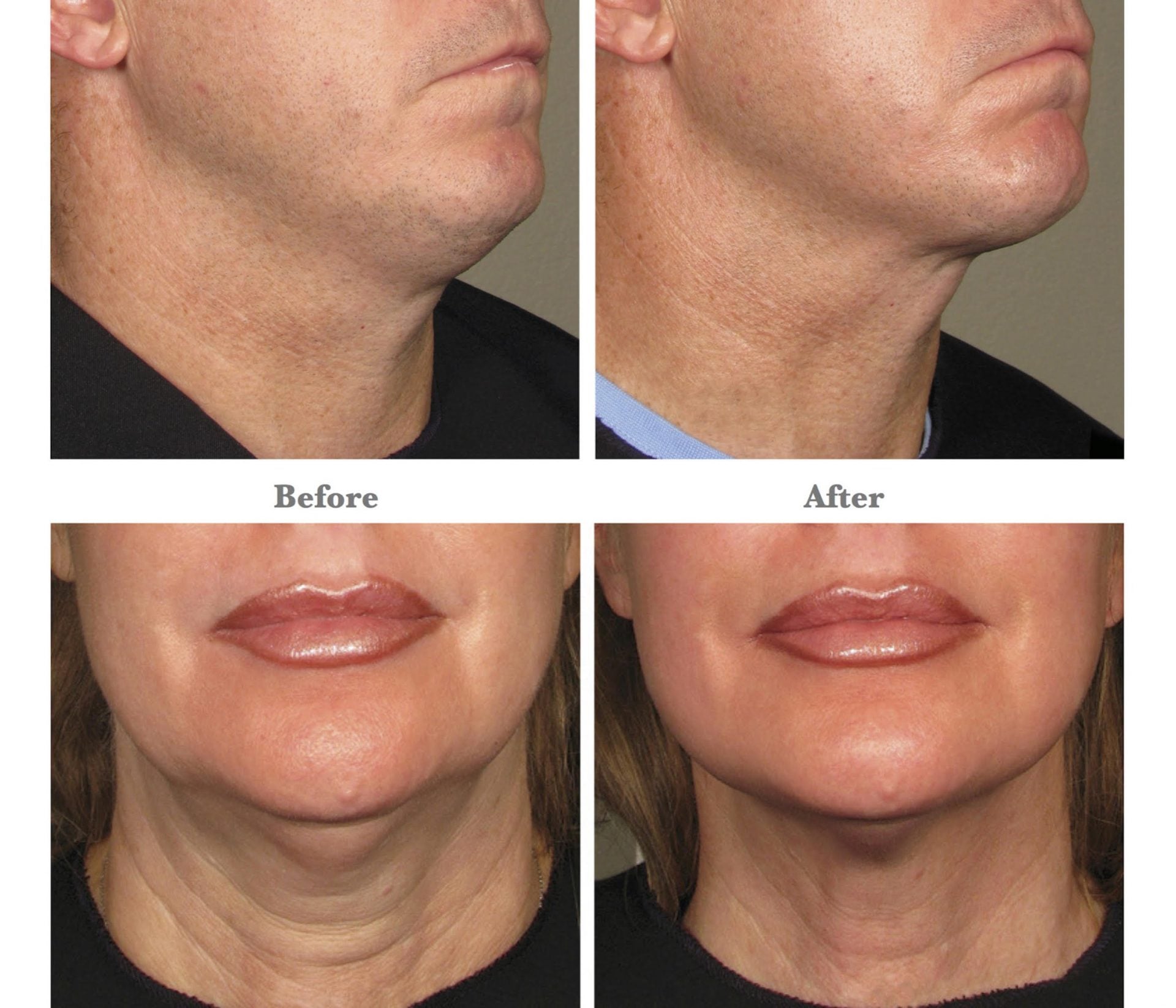 Kim Kardashians Secret Skin Tightening Treatment Zcosmetic Health